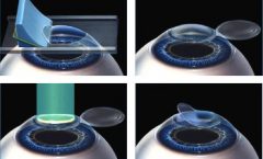 microkeratome-lasik - Centre Ophtalmologique Agora